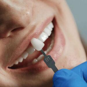 Temporary Veneers: Enhancing Your Smile with a Quick Solution – Smile ...